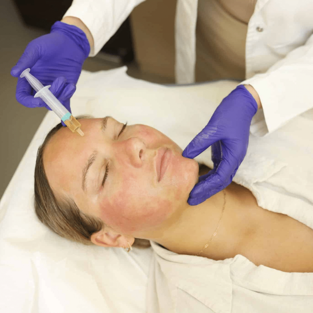 Discover Vampire Facials at Omniya Clinic | Omniya Clinic London