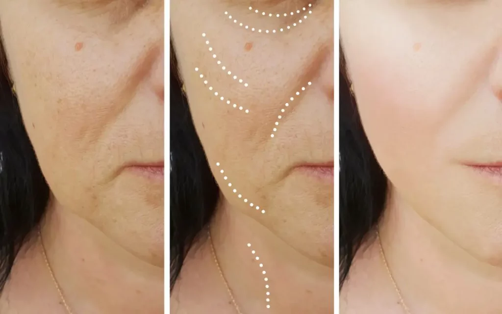 What is an Non-surgical, 8-point Face Lift? | London | Omniya Clinic